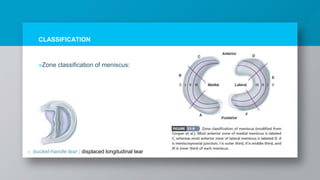Meniscus injury | PPT