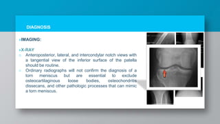 Meniscus injury | PPT