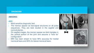 Meniscus injury | PPT