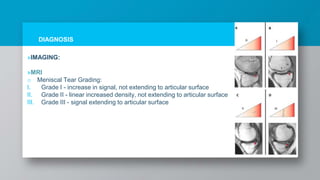 Meniscus injury | PPT