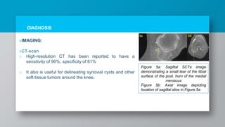 Meniscus injury | PPT