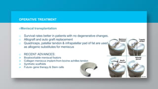Meniscus injury | PPT