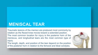 Meniscus injury | PPT