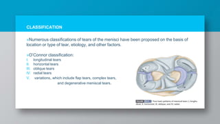 Meniscus injury | PPT
