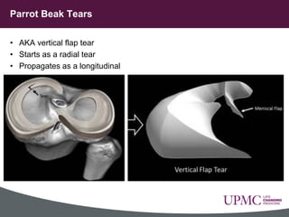 meniscus-injuries.pptx