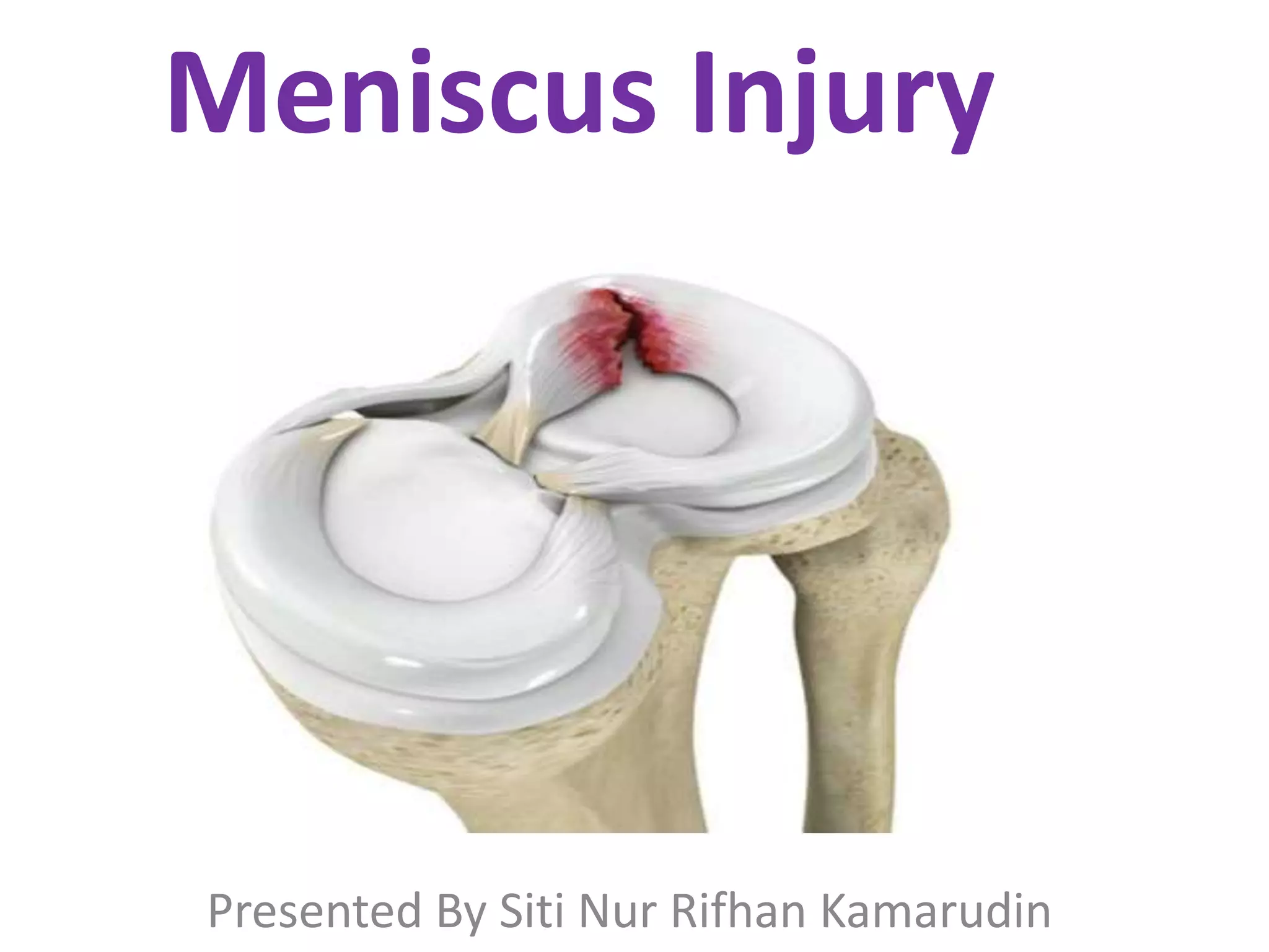 Meniscus injury | PPTX