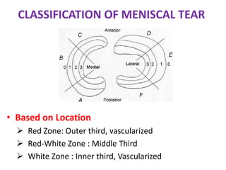 Meniscus injury | PPT
