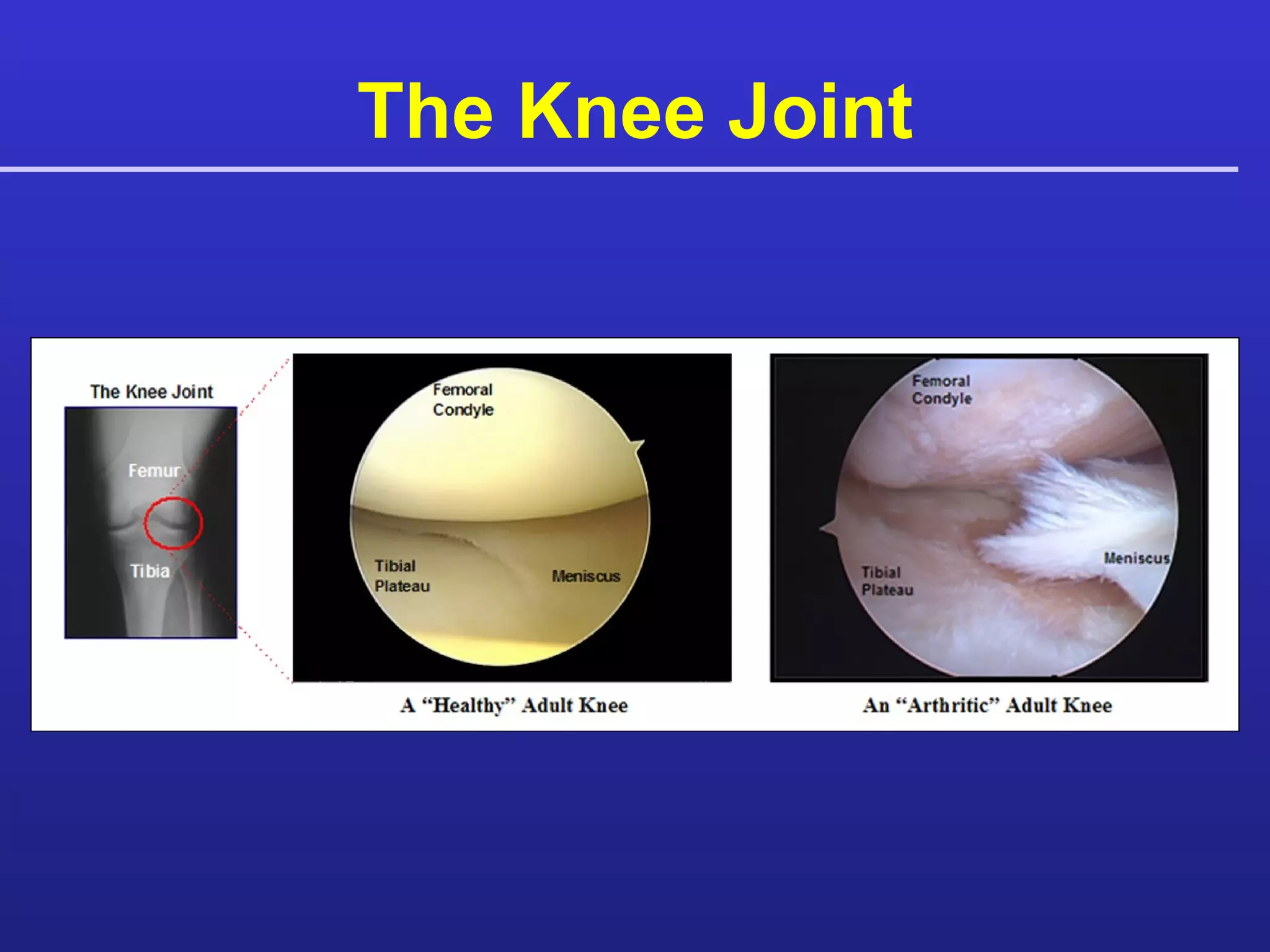 Meniscus Transplant and Replacement | PPT