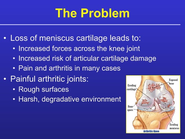 Meniscus Transplant and Replacement | PPT