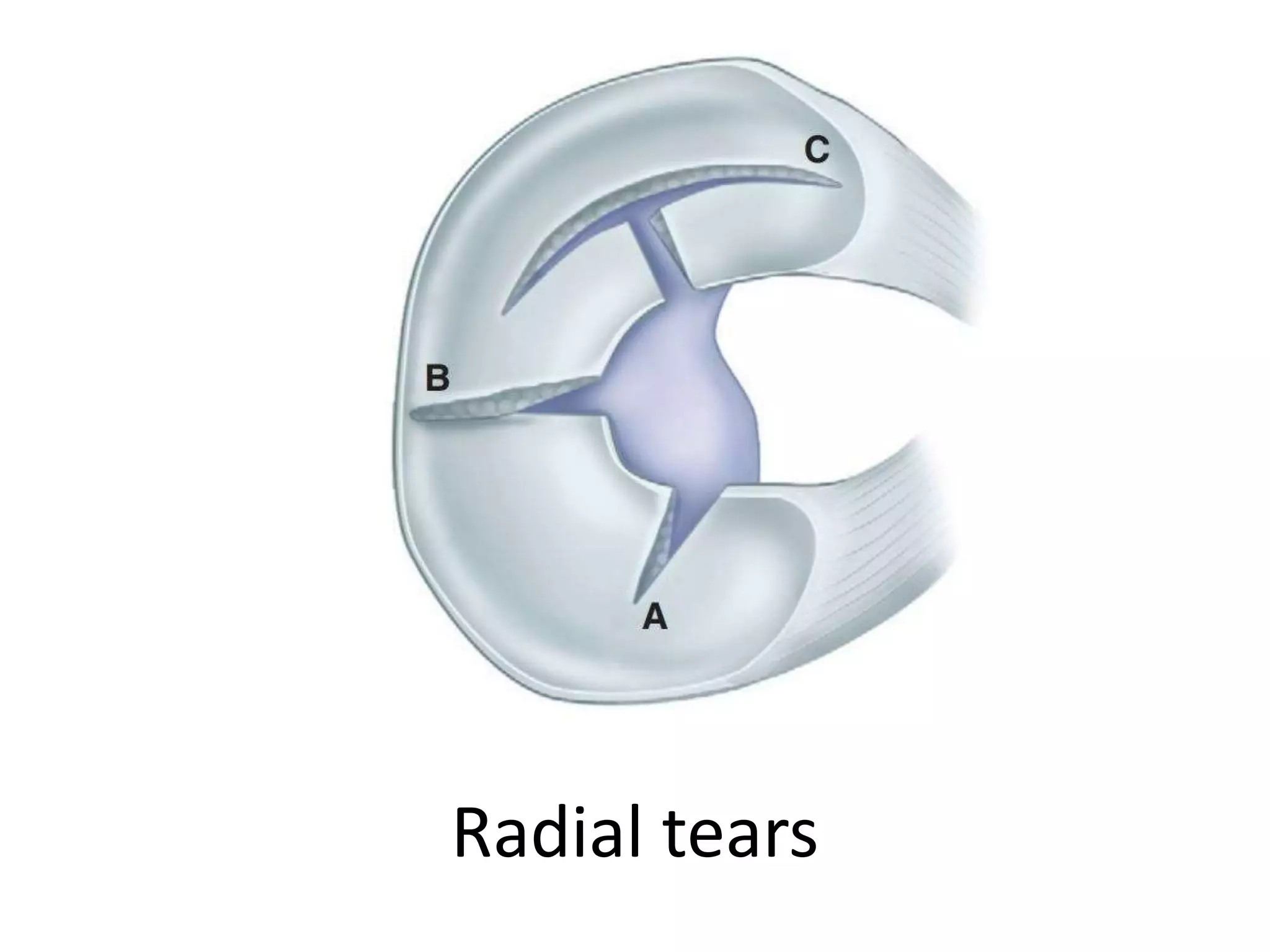 Meniscus - Anatomy, function and injury | PPTX