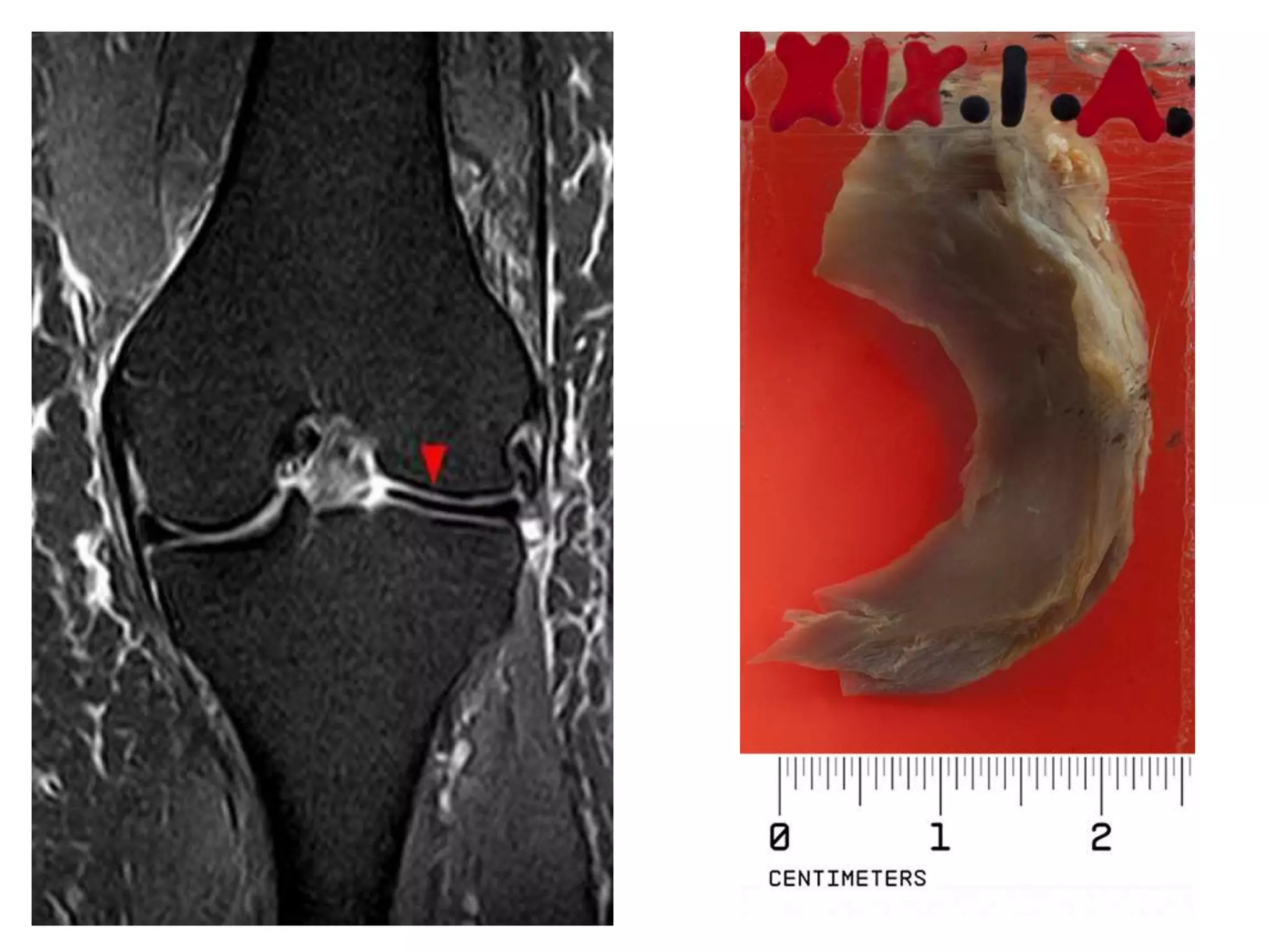 Meniscus - Anatomy, function and injury | PPTX