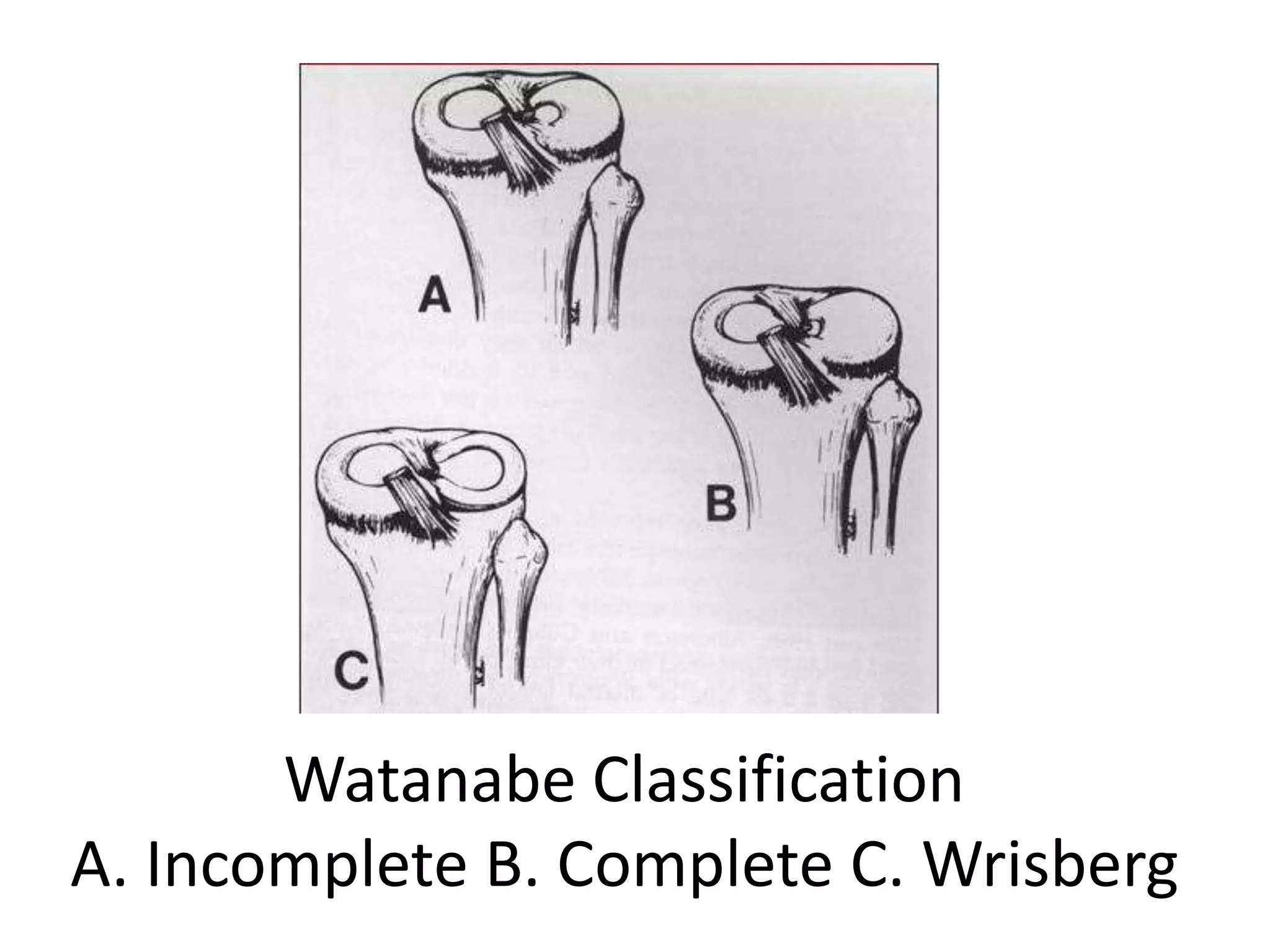 Meniscus - Anatomy, function and injury | PPTX