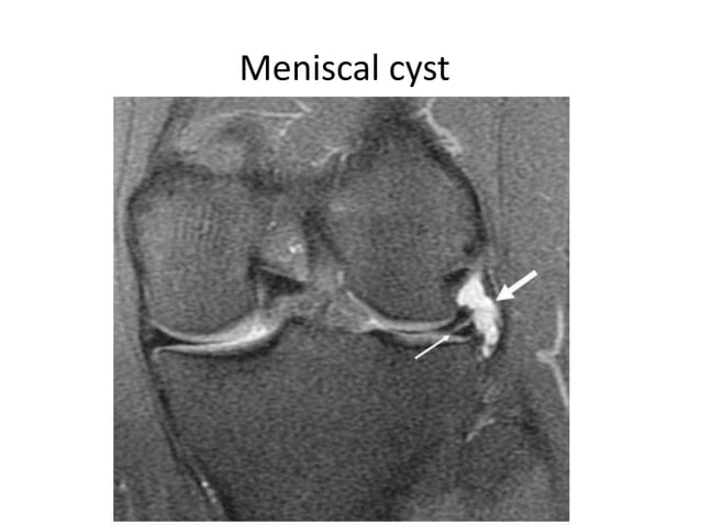 Meniscus - Anatomy, function and injury | PPTX