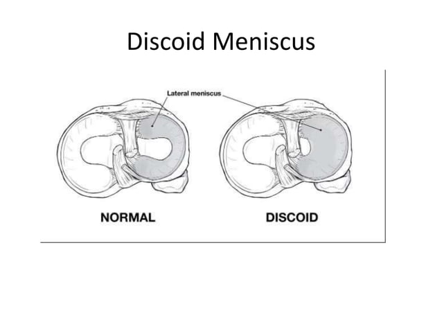 Meniscus - Anatomy, function and injury | PPTX