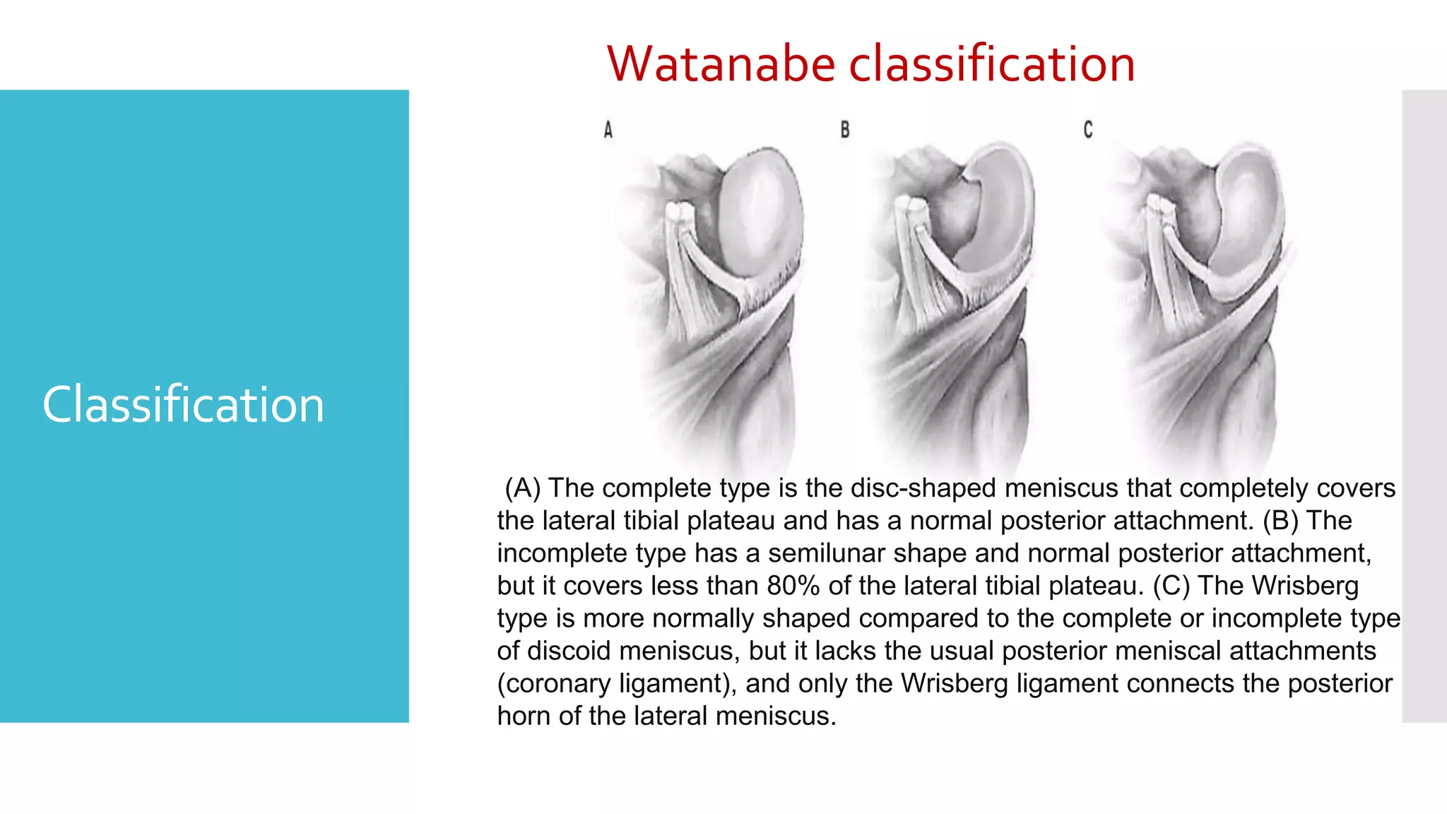 Discoid Meniscus | PPTX