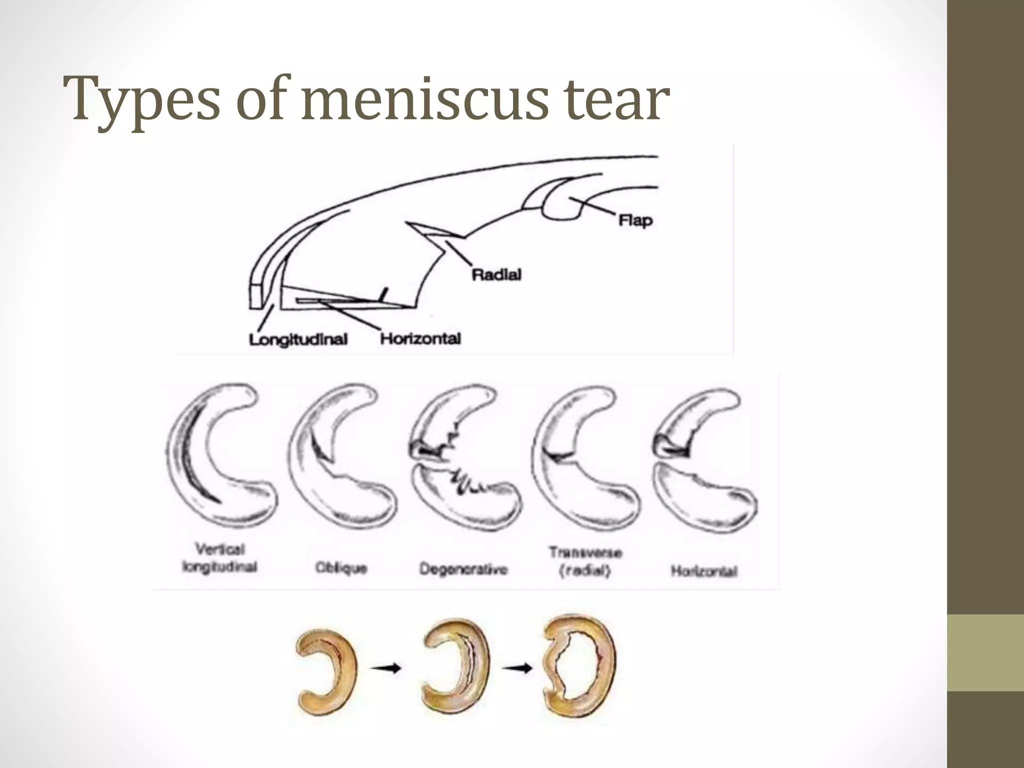 Meniscus injury / tear | PPTX