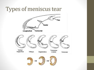 Meniscus injury / tear | PPTX