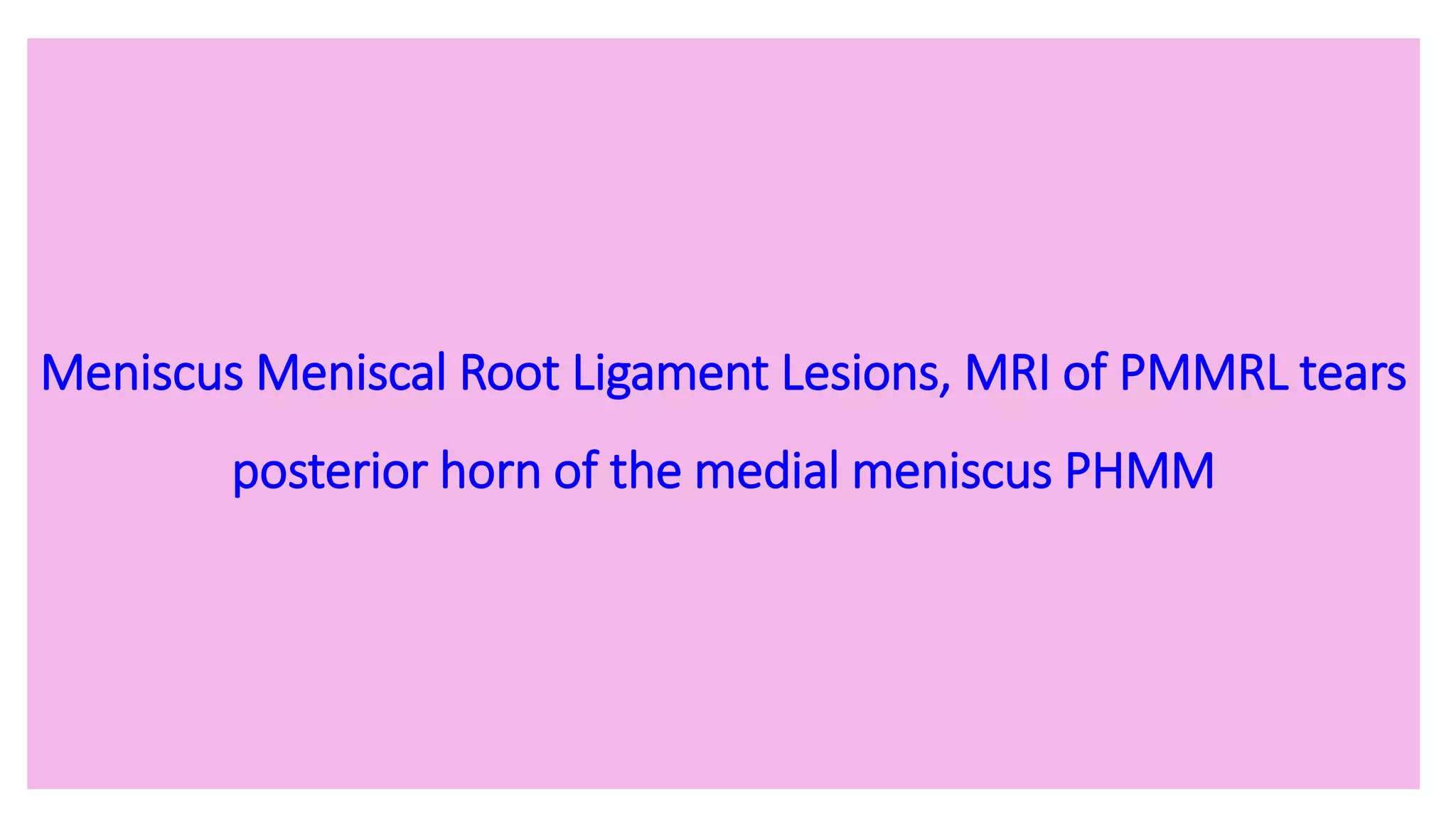 Meniscus Meniscal Root Ligament Lesions, MRI of PMMRL tears posterior ...