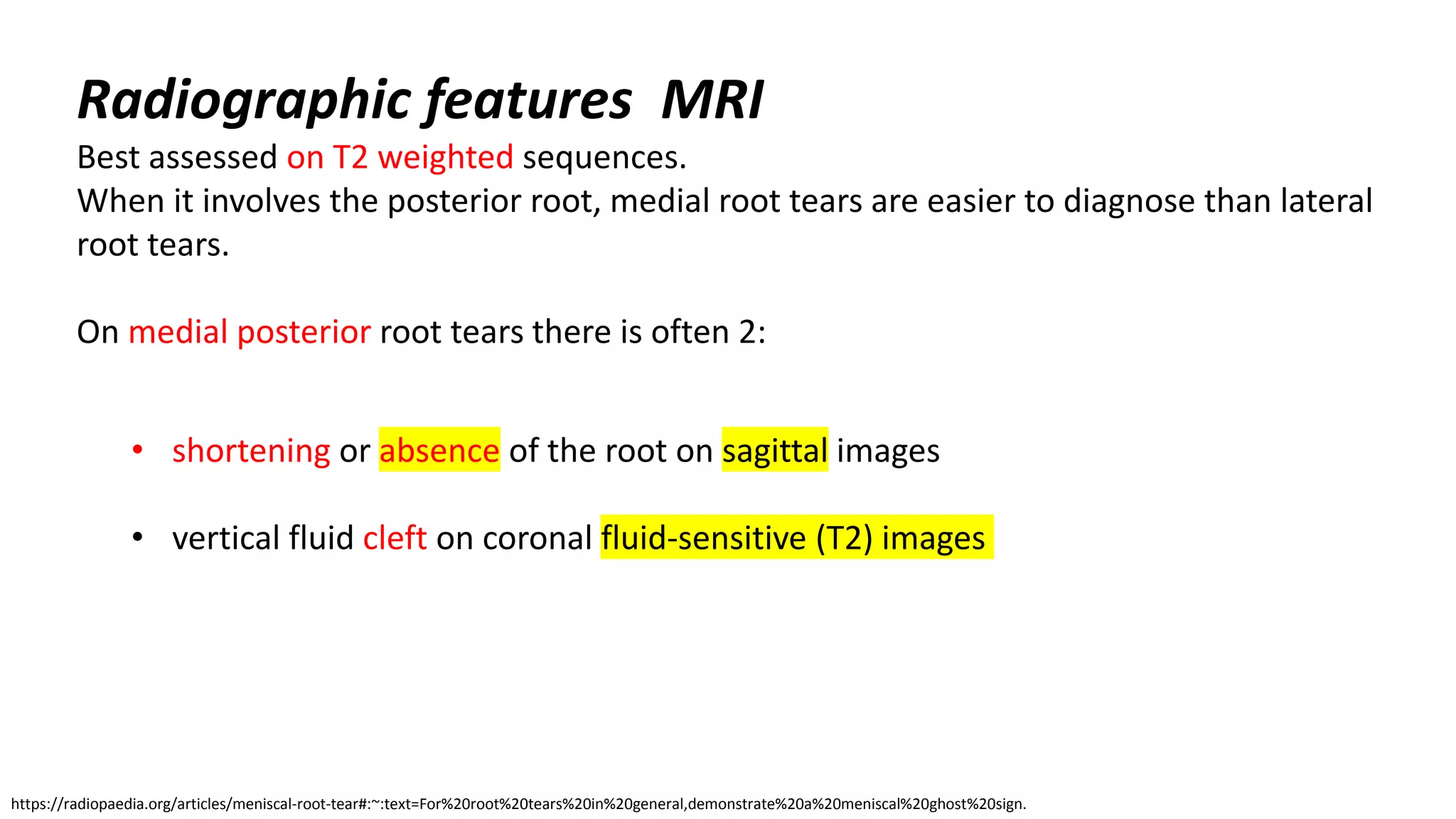 Meniscus Meniscal Root Ligament Lesions, MRI of PMMRL tears posterior ...