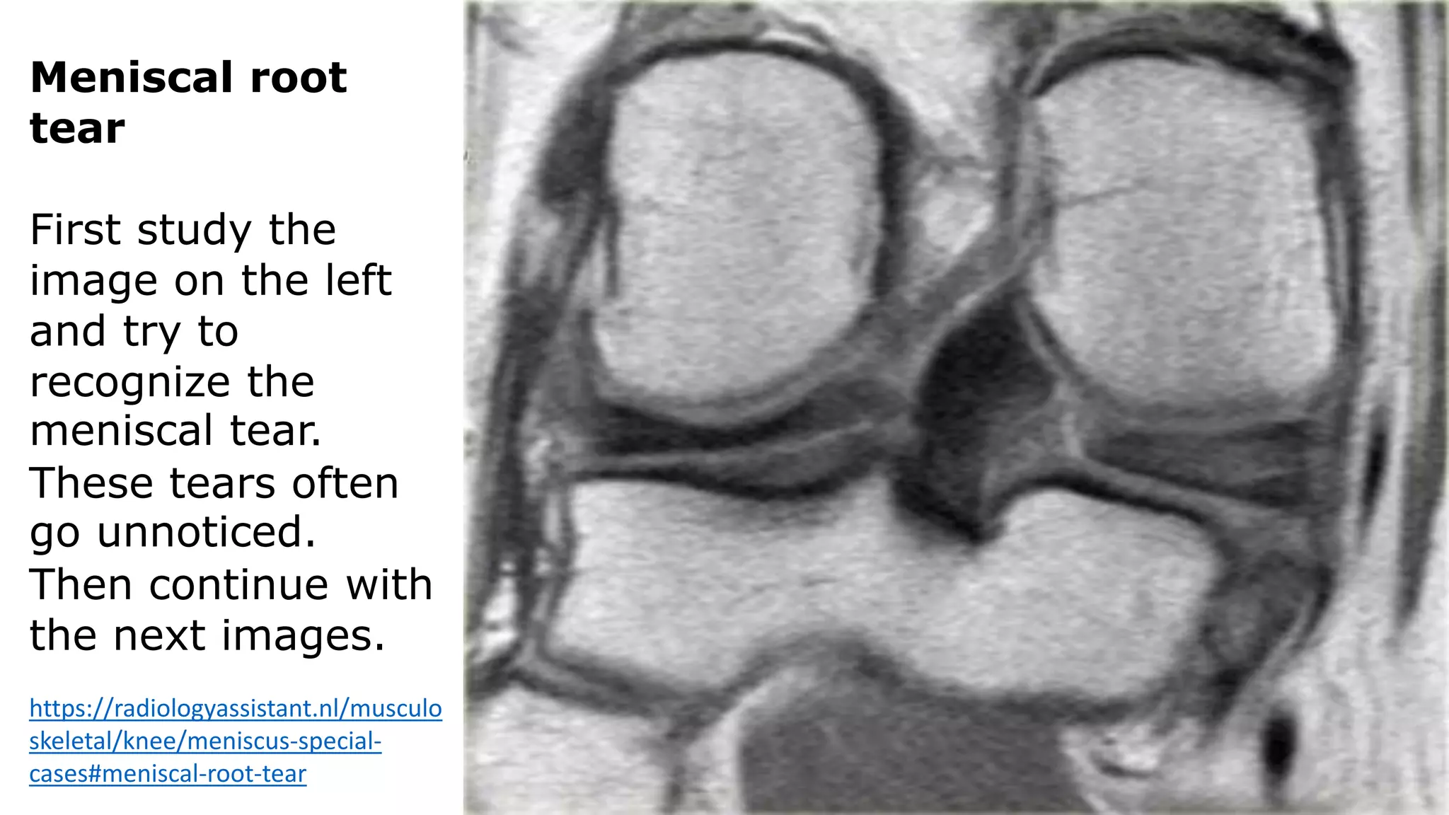 Meniscus Meniscal Root Ligament Lesions, MRI of PMMRL tears posterior ...
