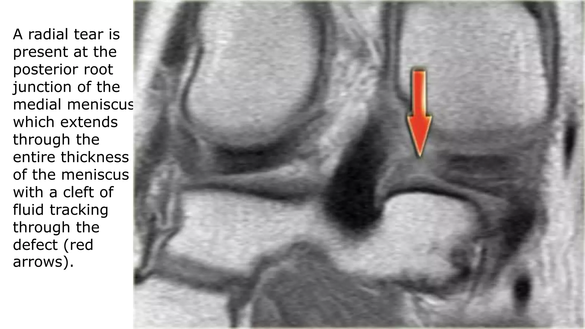 Meniscus Meniscal Root Ligament Lesions, MRI of PMMRL tears posterior ...