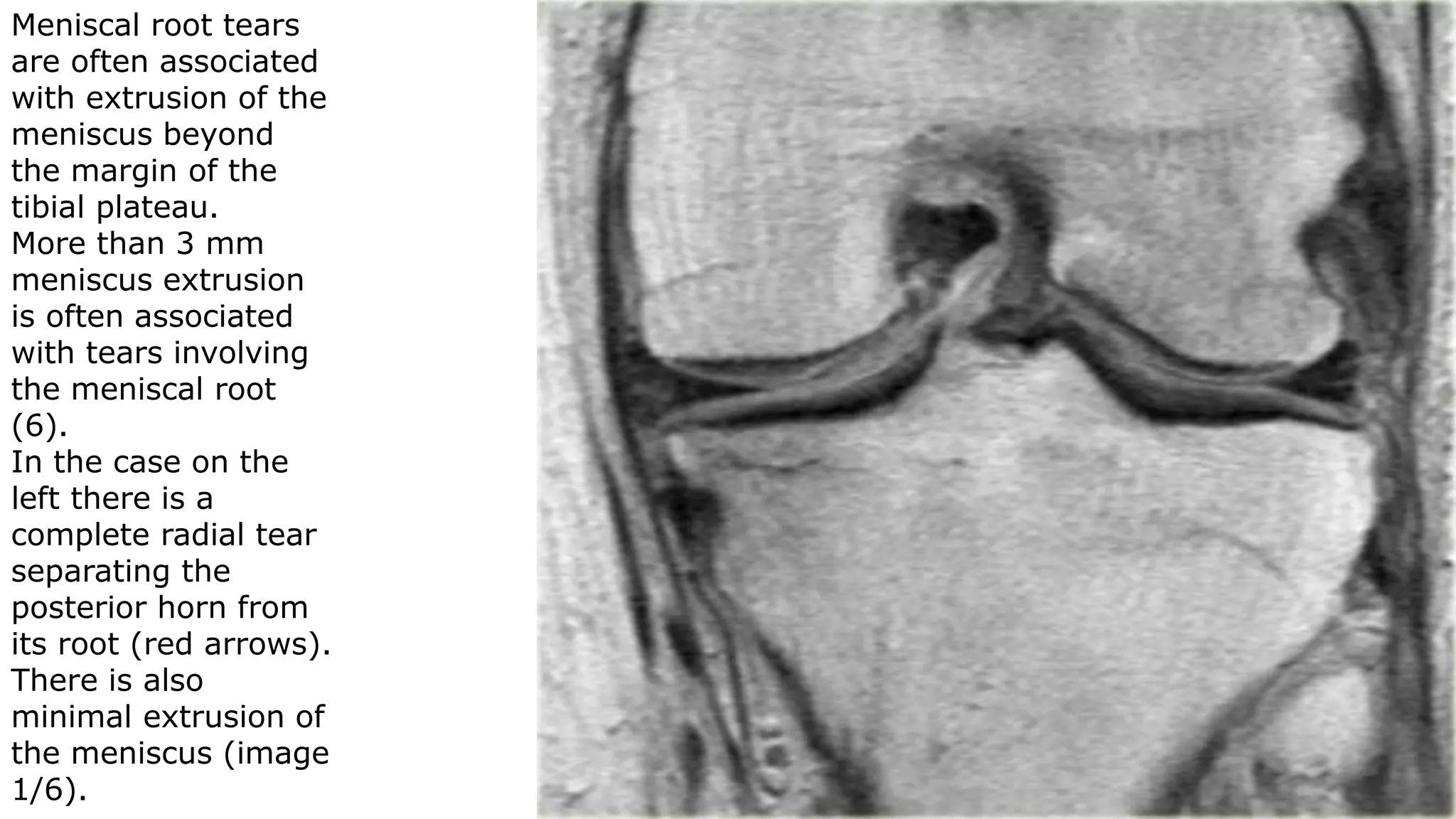 Meniscus Meniscal Root Ligament Lesions, MRI of PMMRL tears posterior ...