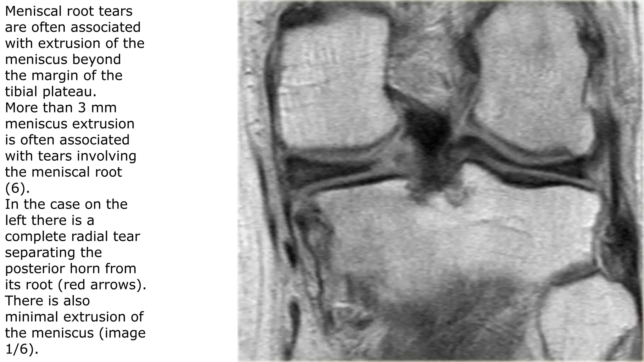 Meniscus Meniscal Root Ligament Lesions, MRI of PMMRL tears posterior ...