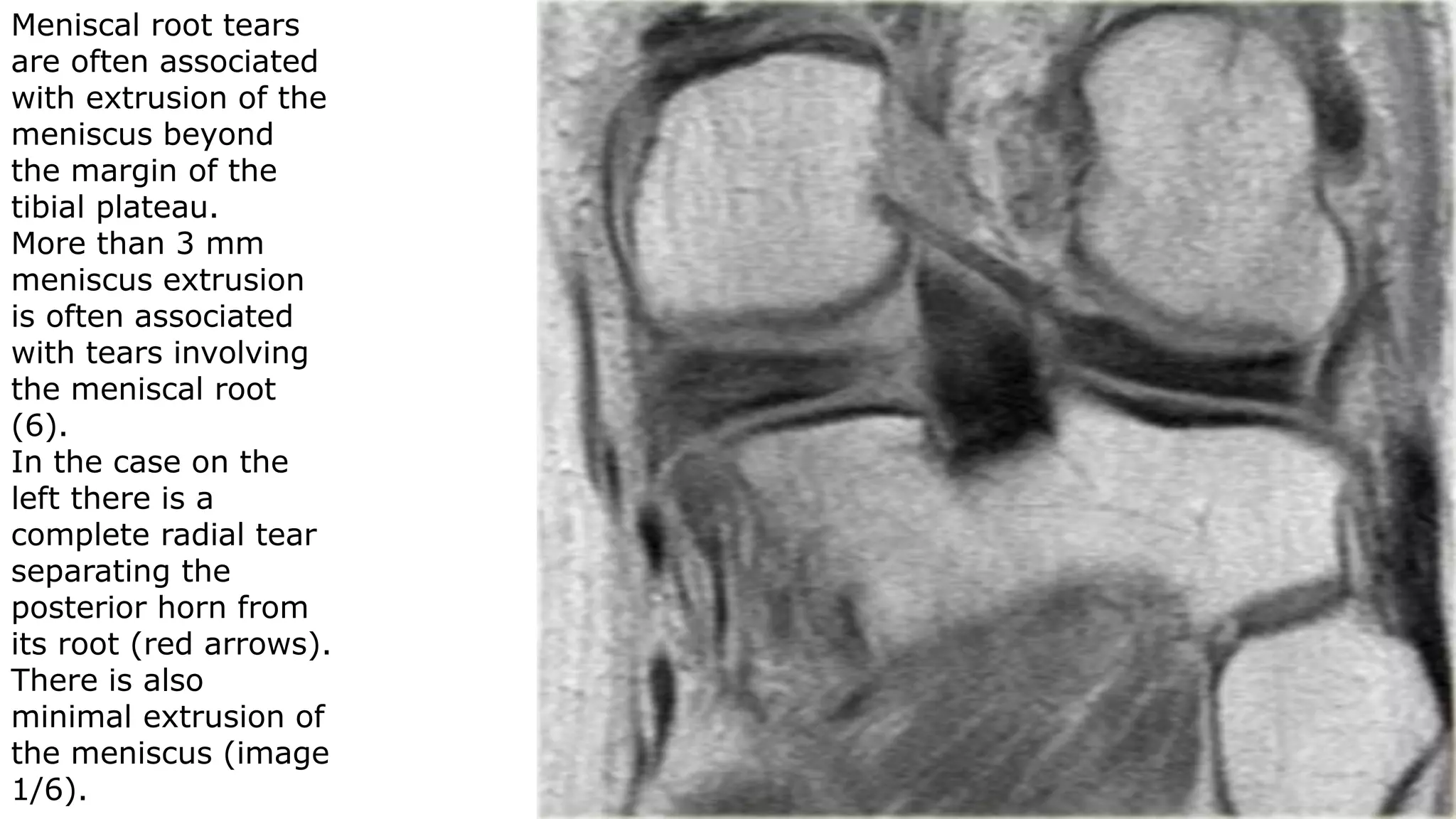 Meniscus Meniscal Root Ligament Lesions, MRI of PMMRL tears posterior ...