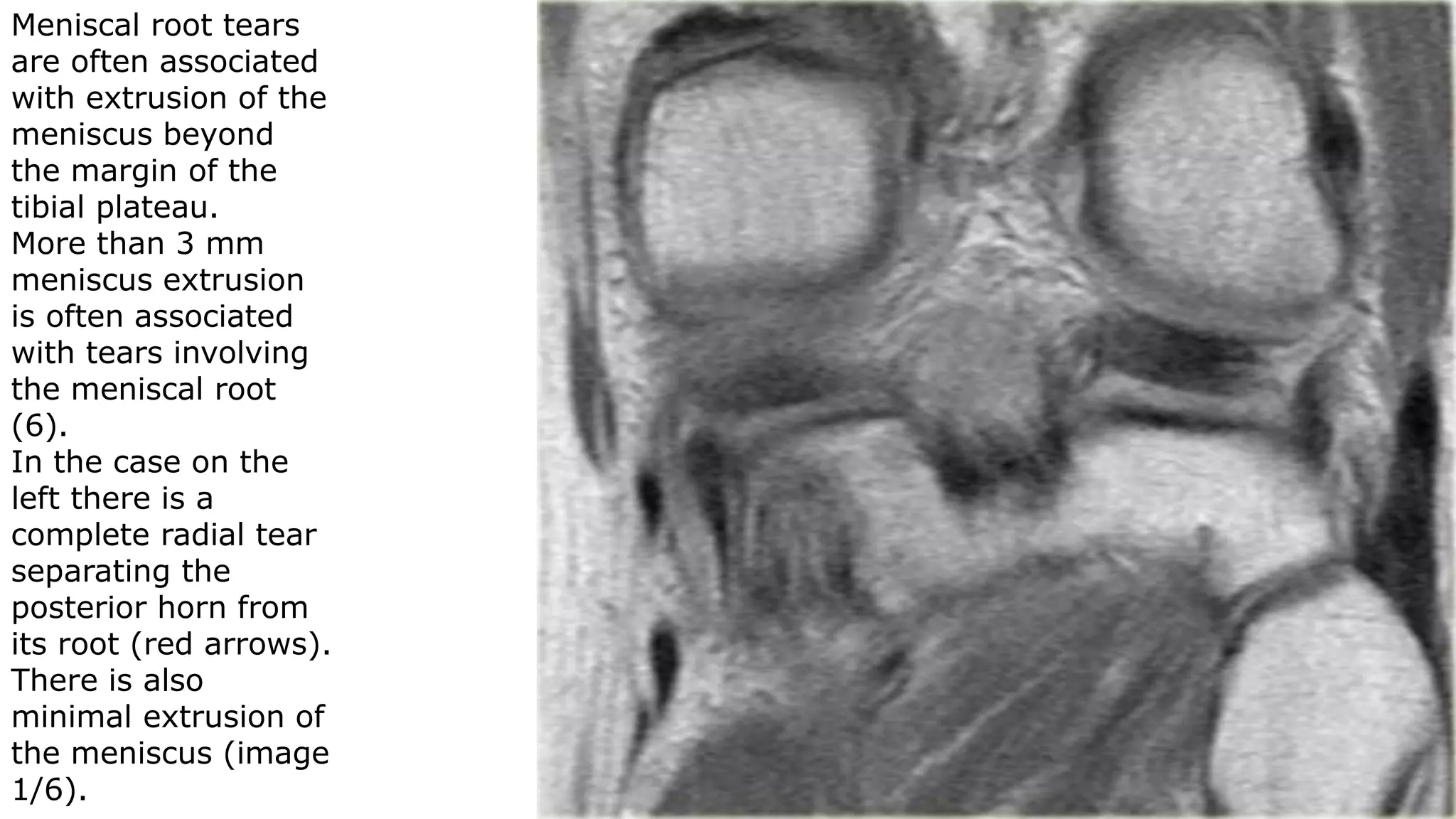 Meniscus Meniscal Root Ligament Lesions, MRI of PMMRL tears posterior ...