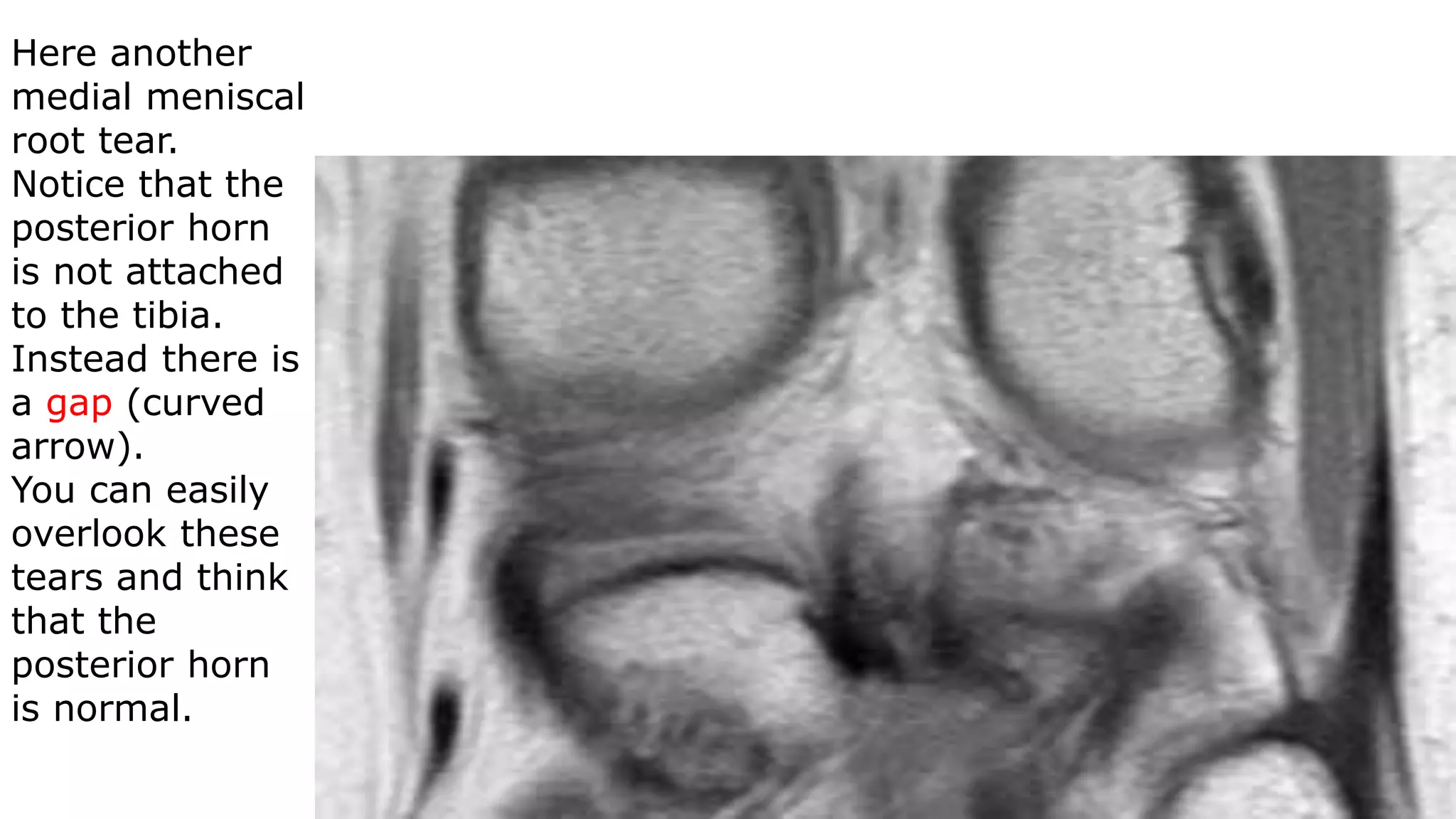 Meniscus Meniscal Root Ligament Lesions, MRI of PMMRL tears posterior ...