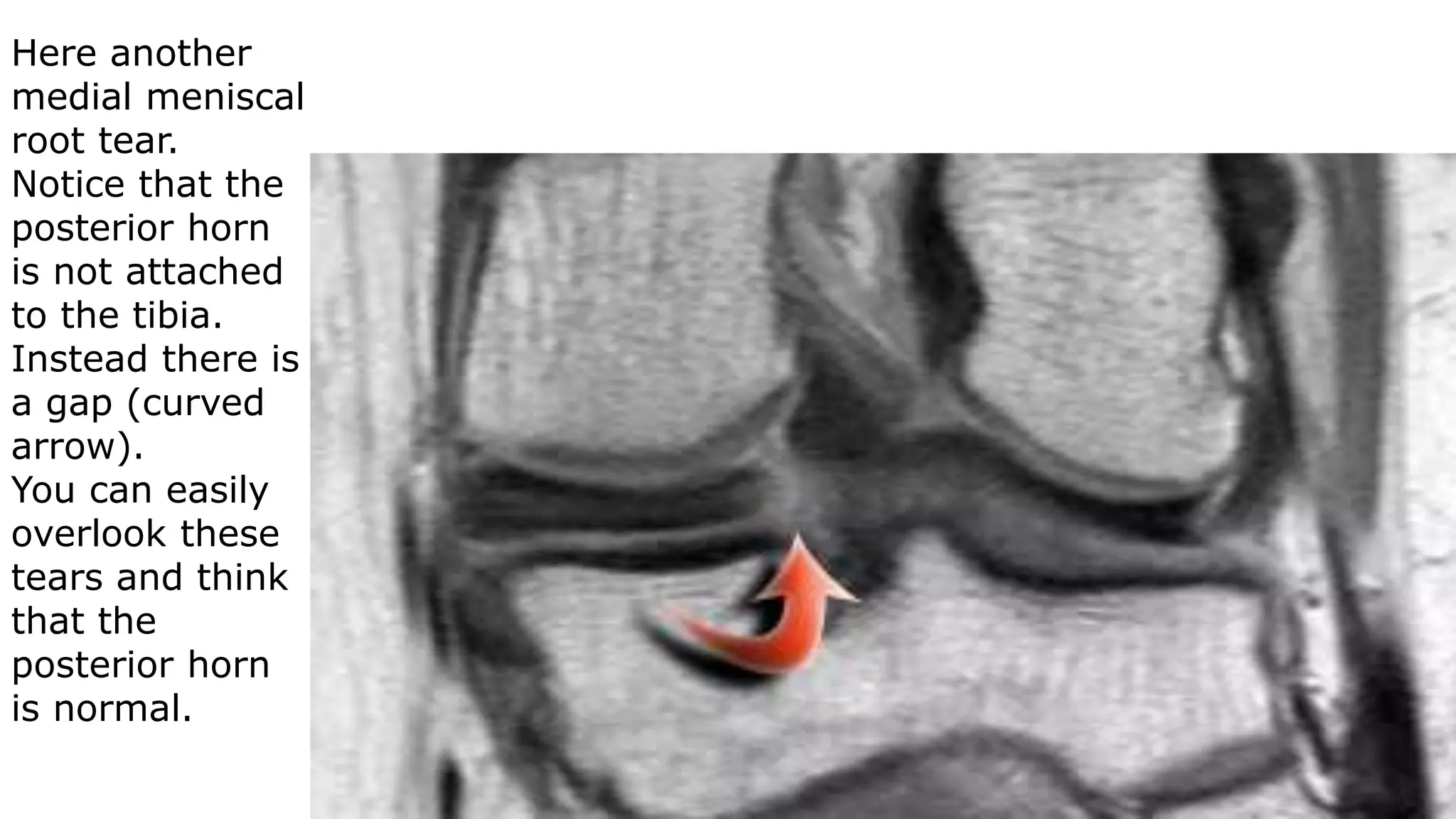 Meniscus Meniscal Root Ligament Lesions, MRI of PMMRL tears posterior ...