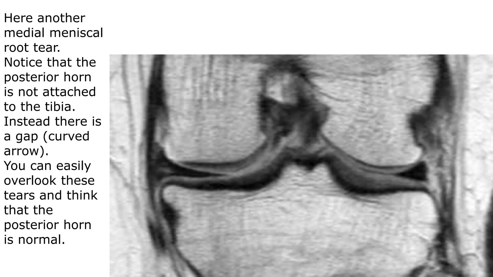 Meniscus Meniscal Root Ligament Lesions, MRI of PMMRL tears posterior ...