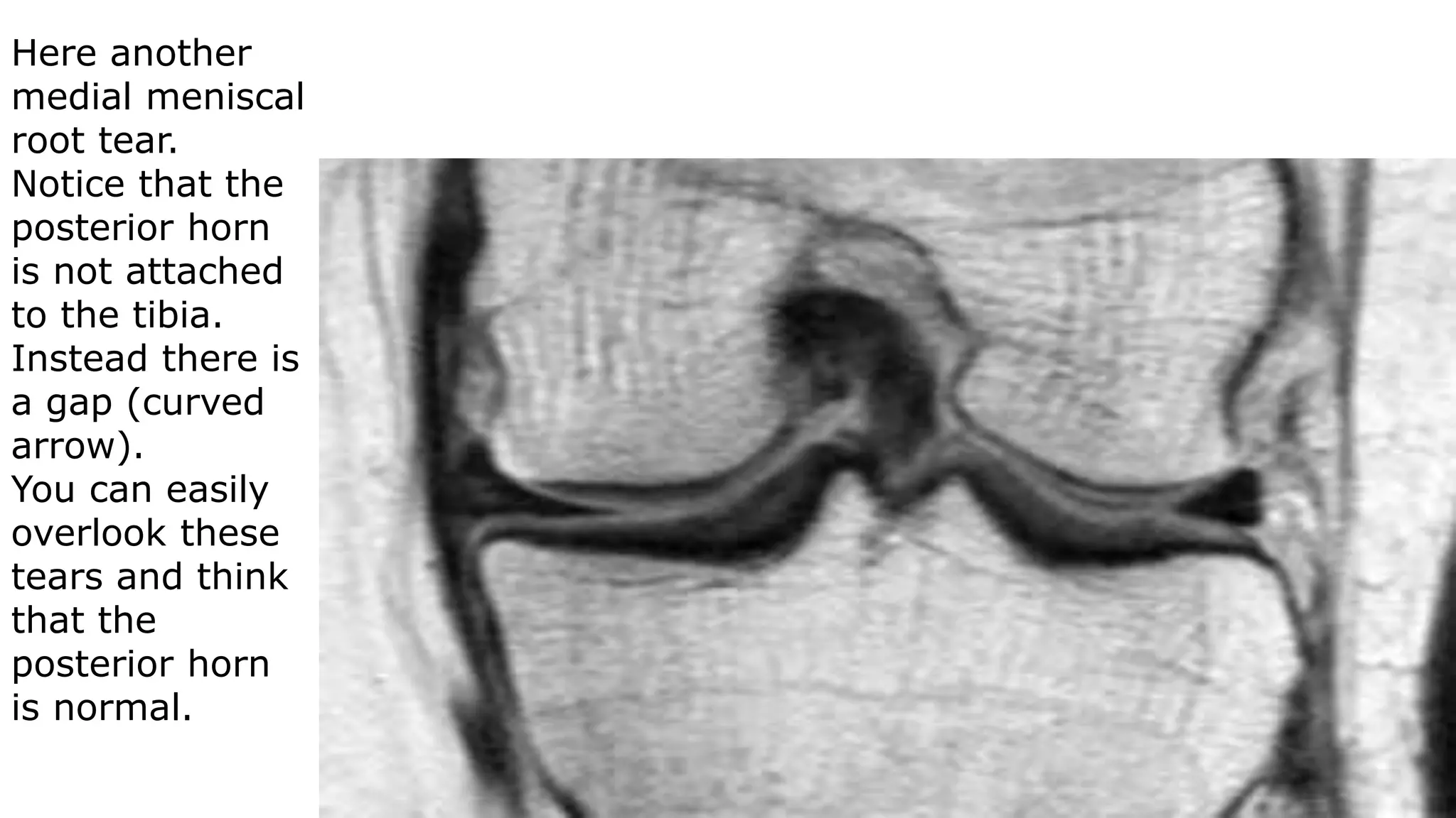 Meniscus Meniscal Root Ligament Lesions, MRI of PMMRL tears posterior ...