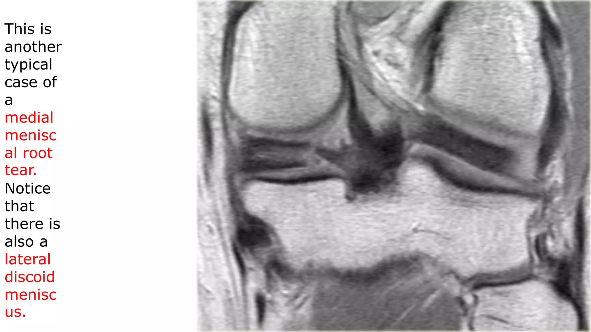 Meniscus Meniscal Root Ligament Lesions, MRI of PMMRL tears posterior ...