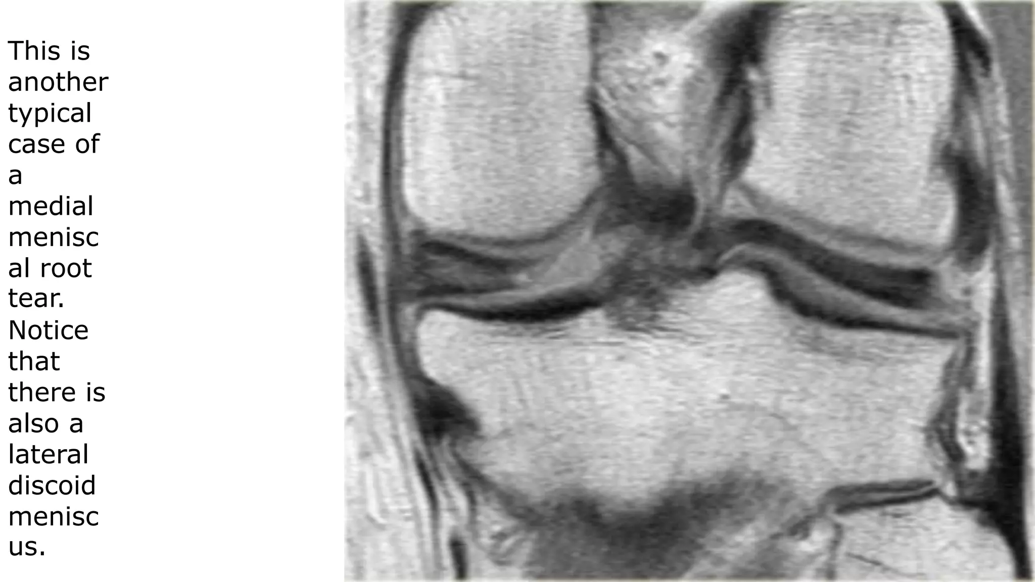 Meniscus Meniscal Root Ligament Lesions, MRI of PMMRL tears posterior ...