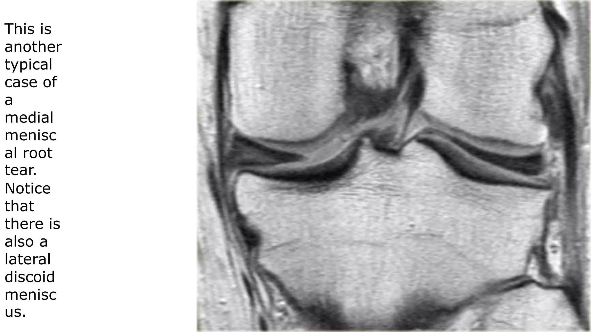 Meniscus Meniscal Root Ligament Lesions, MRI of PMMRL tears posterior ...