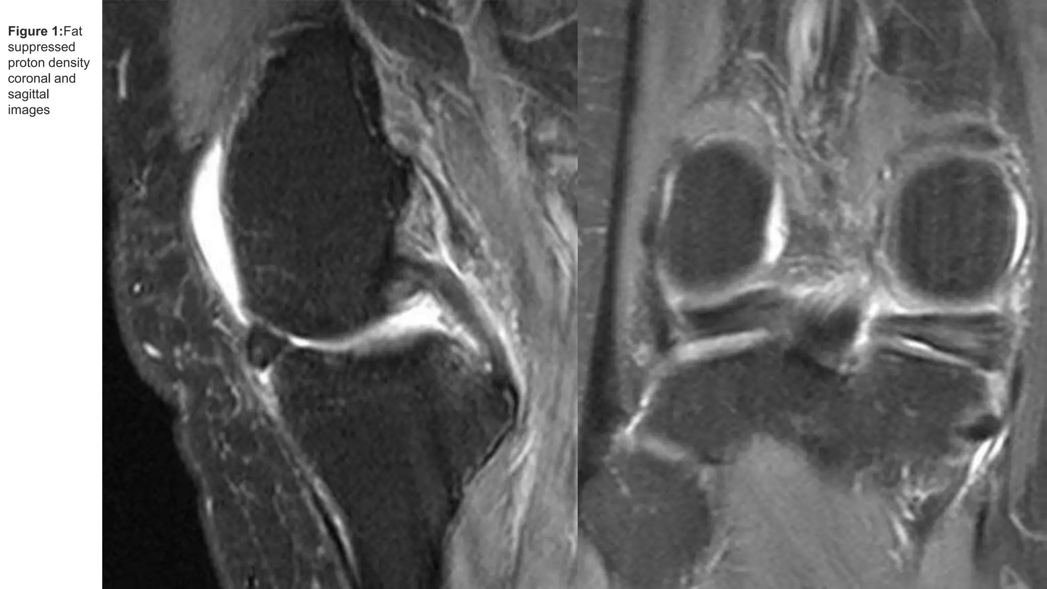 Meniscus Meniscal Root Ligament Lesions, MRI of PMMRL tears posterior ...