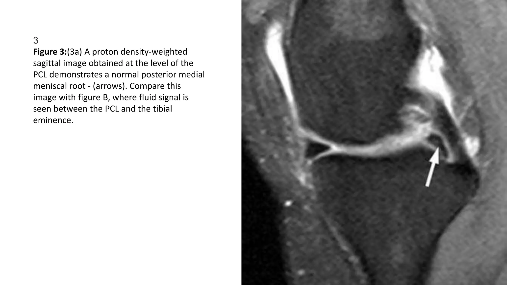 Meniscus Meniscal Root Ligament Lesions, MRI of PMMRL tears posterior ...