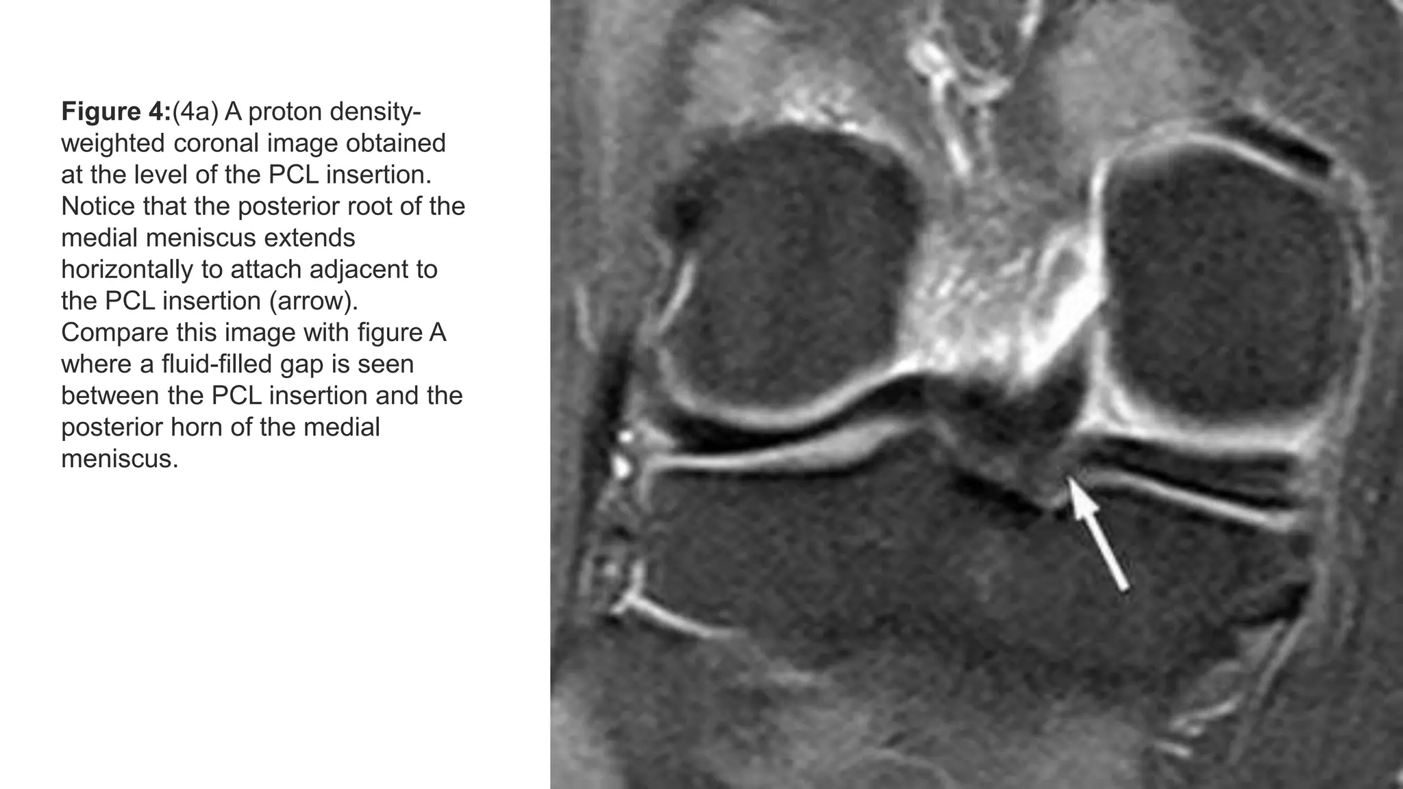 Meniscus Meniscal Root Ligament Lesions, MRI of PMMRL tears posterior ...