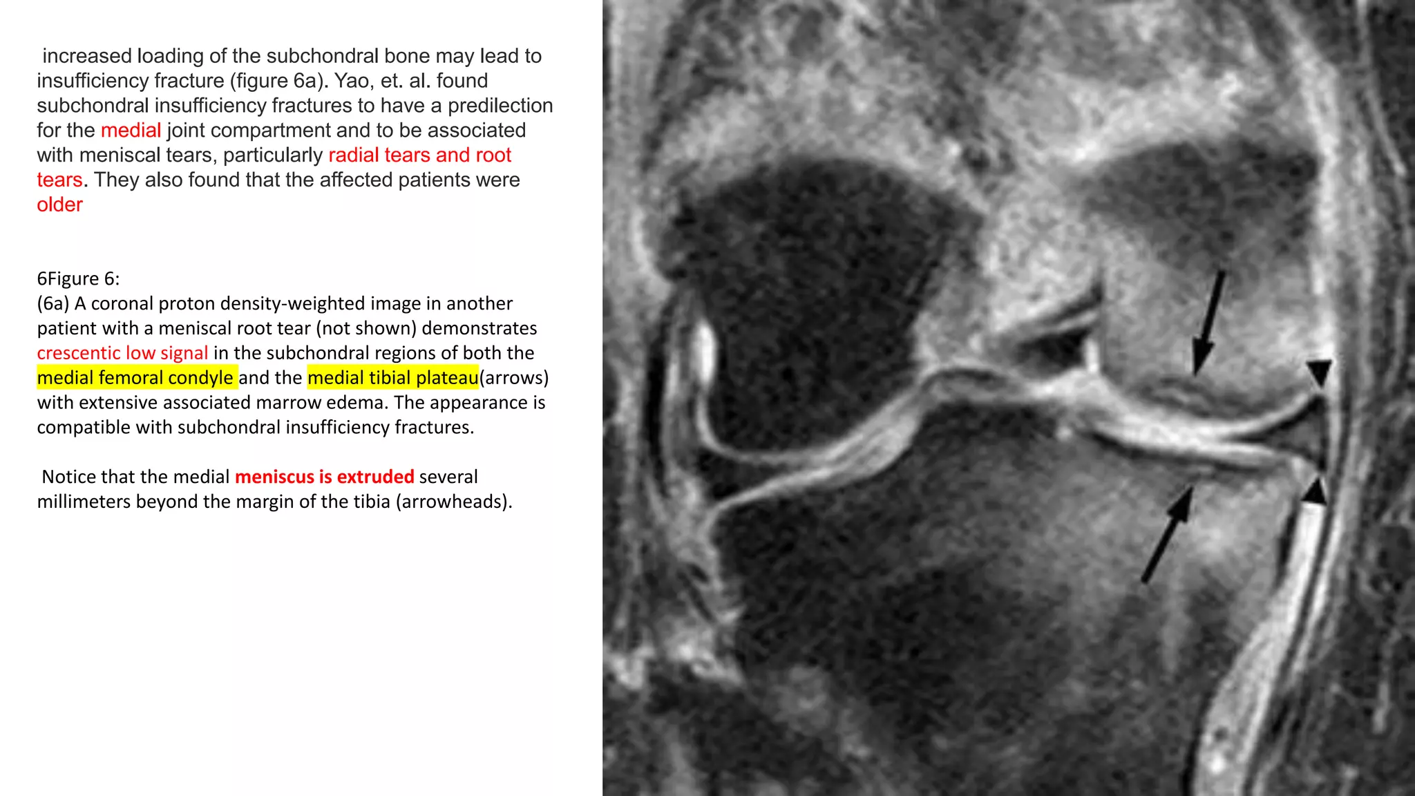Meniscus Meniscal Root Ligament Lesions, MRI of PMMRL tears posterior ...