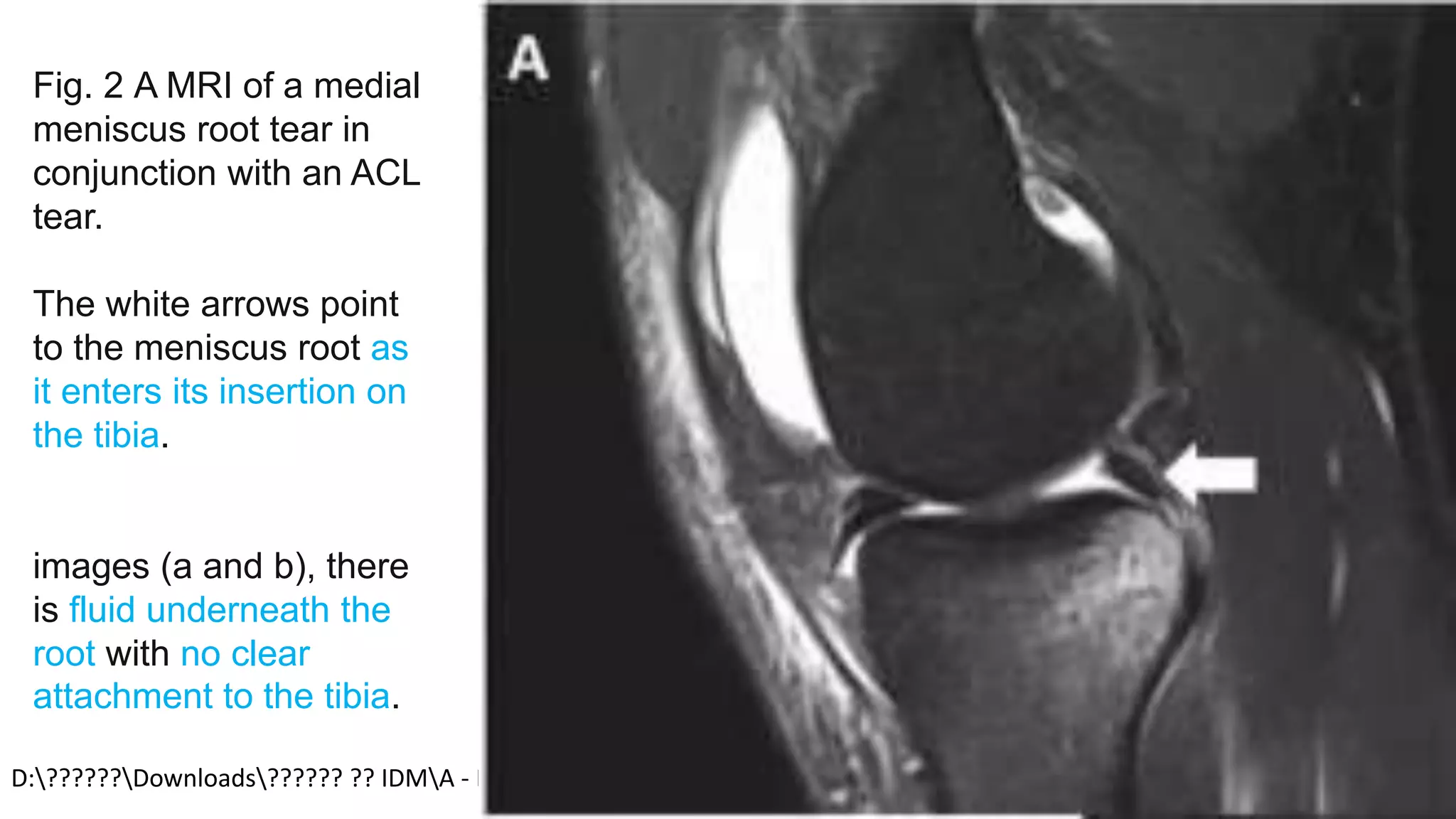 Meniscus Meniscal Root Ligament Lesions, MRI of PMMRL tears posterior ...
