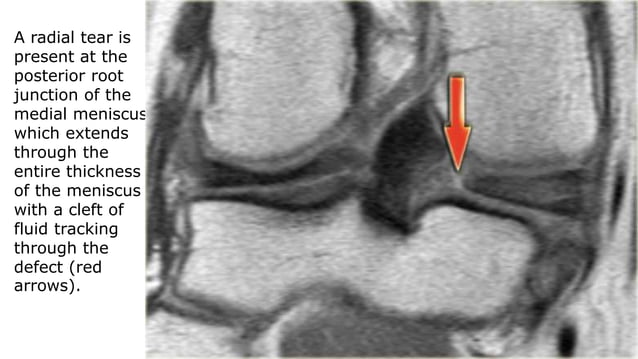 Meniscus Meniscal Root Ligament Lesions, MRI of PMMRL tears posterior ...