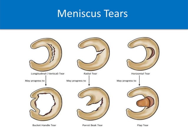 Meniscus: Structure, Role & Injury. | PPTX | Death, Injury, or Military ...