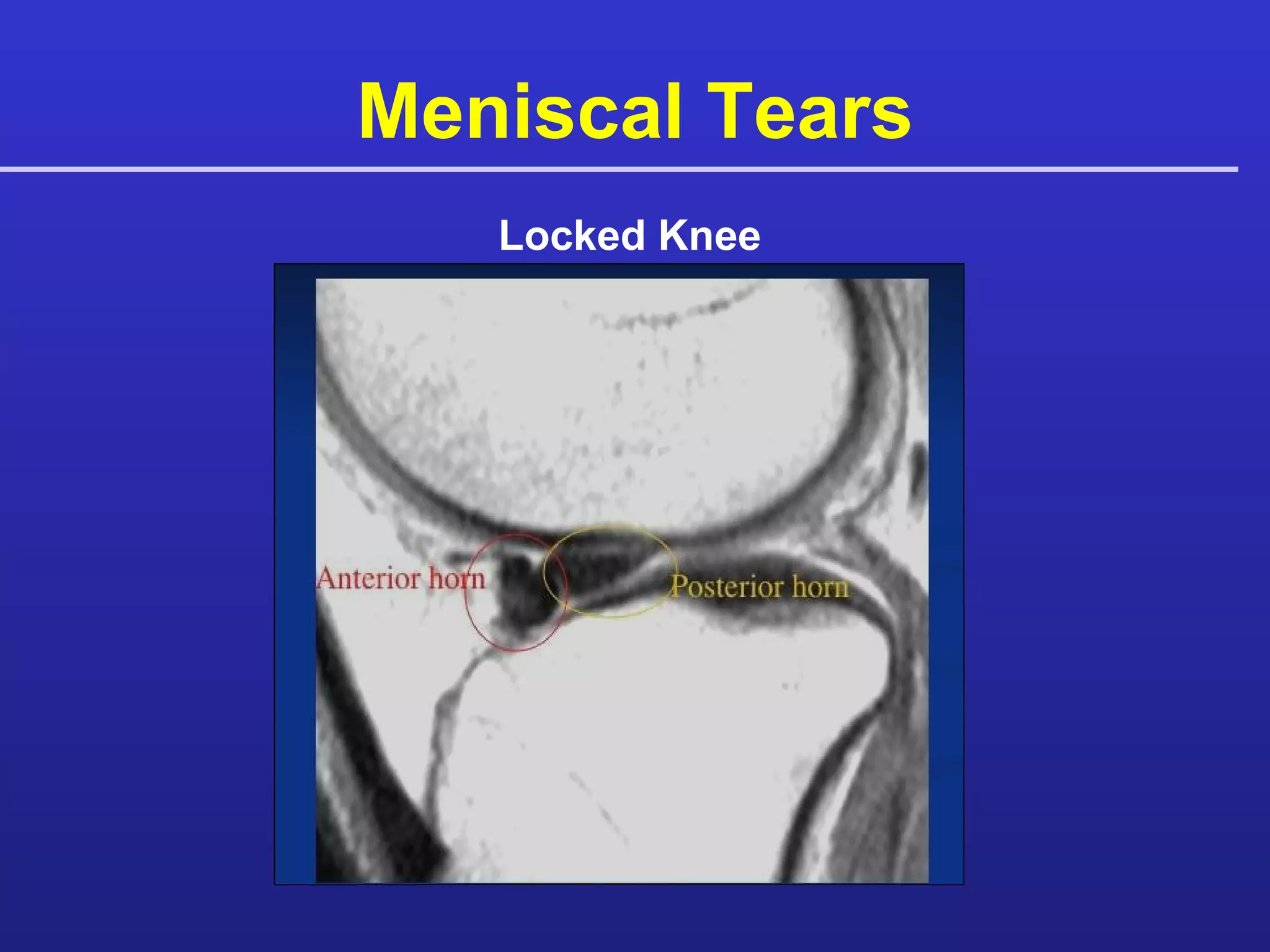 Meniscus repair | PPT