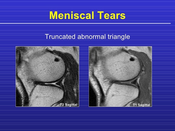 Meniscus repair