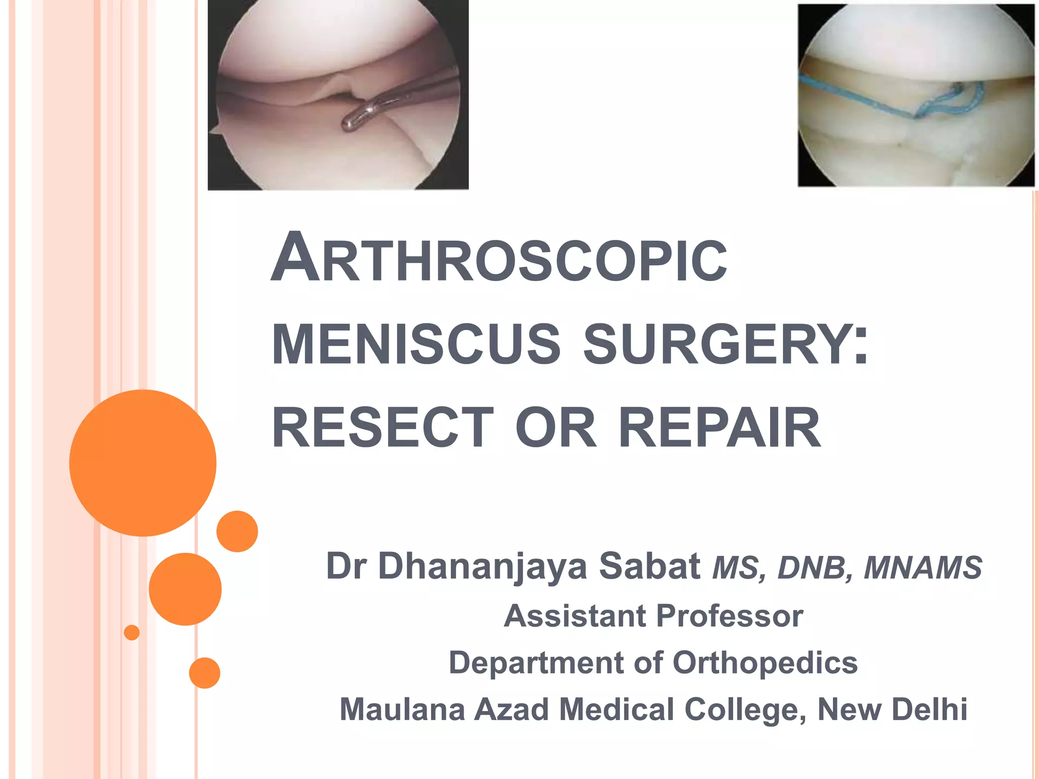 Arthroscopic Meniscus Surgery: Resect or Repair 2014 | PPTX