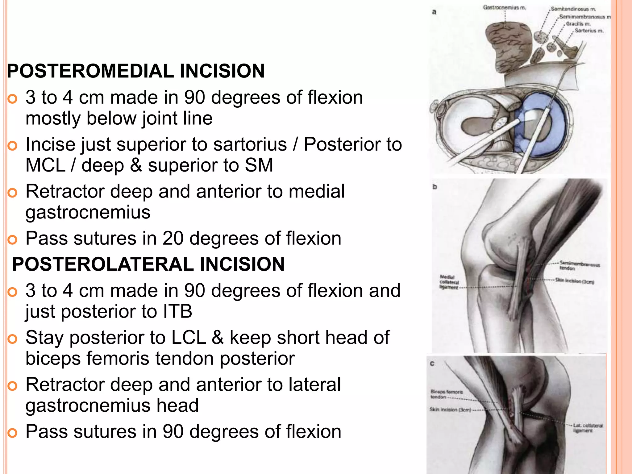 Arthroscopic Meniscus Surgery: Resect or Repair 2014 | PPTX