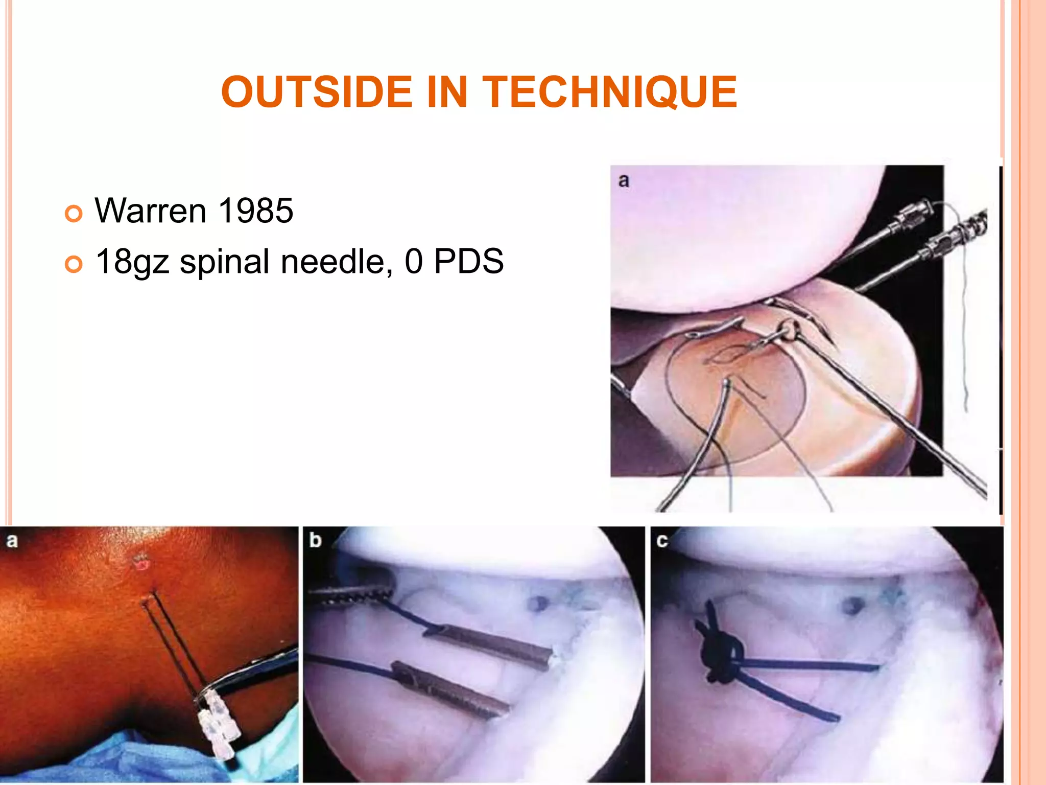 Arthroscopic Meniscus Surgery: Resect or Repair 2014 | PPTX