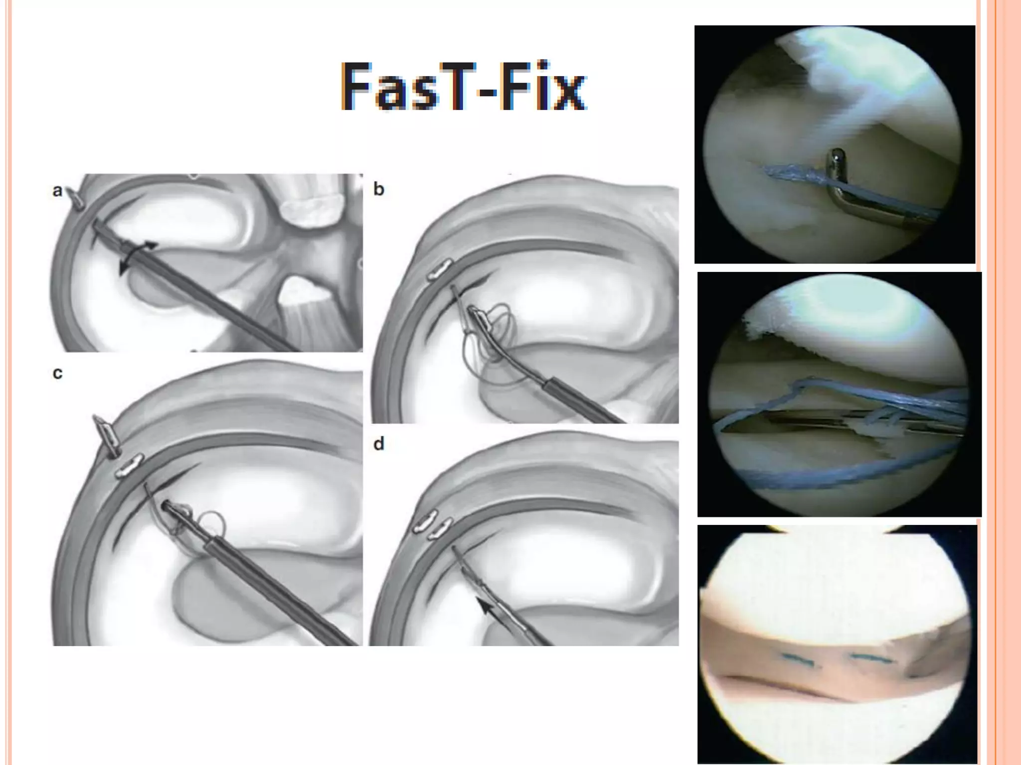 Arthroscopic Meniscus Surgery: Resect or Repair 2014 | PPTX