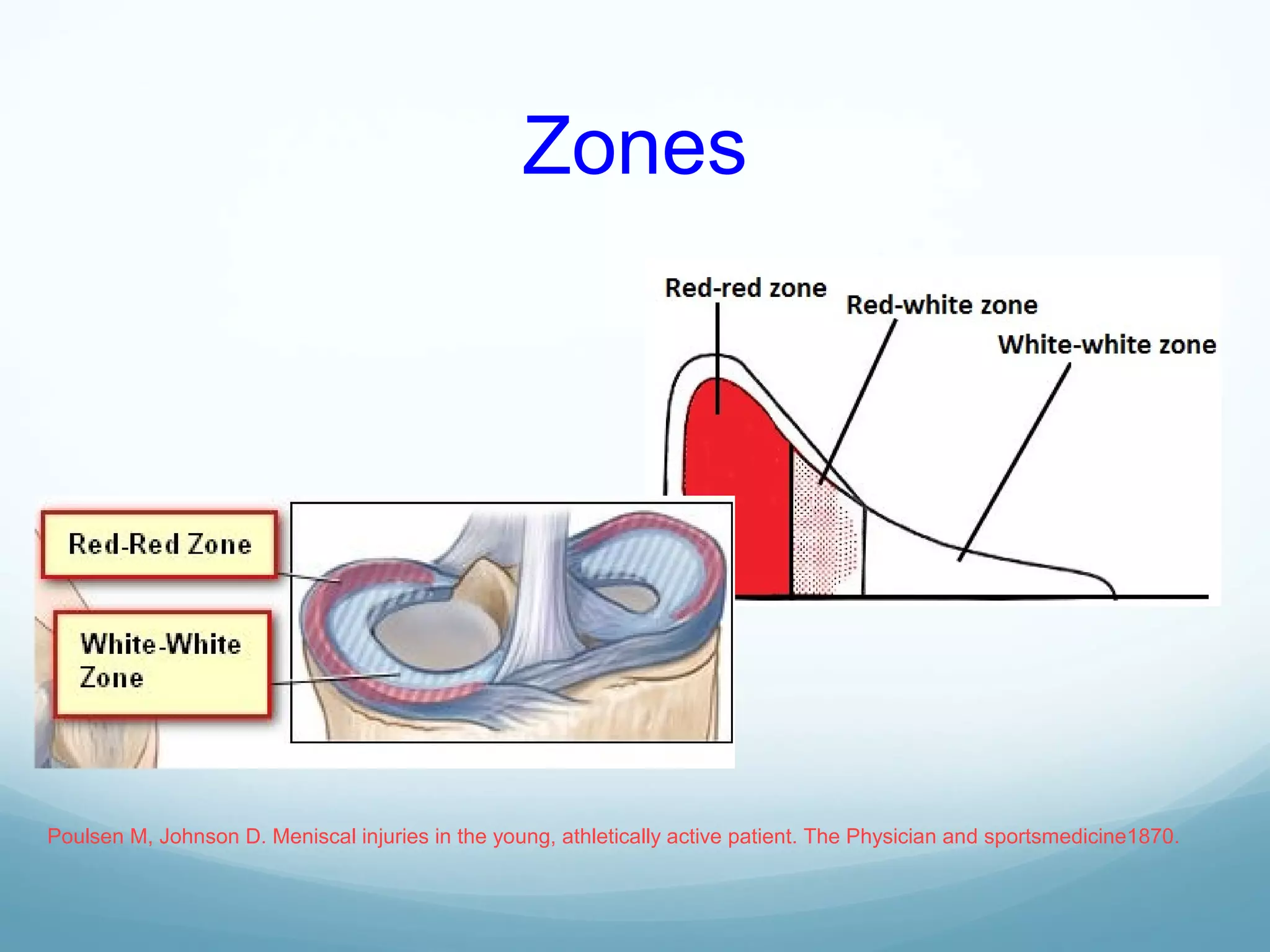 MENISCUS REPAIR I Dr.RAJAT JANGIR JAIPUR | PPT